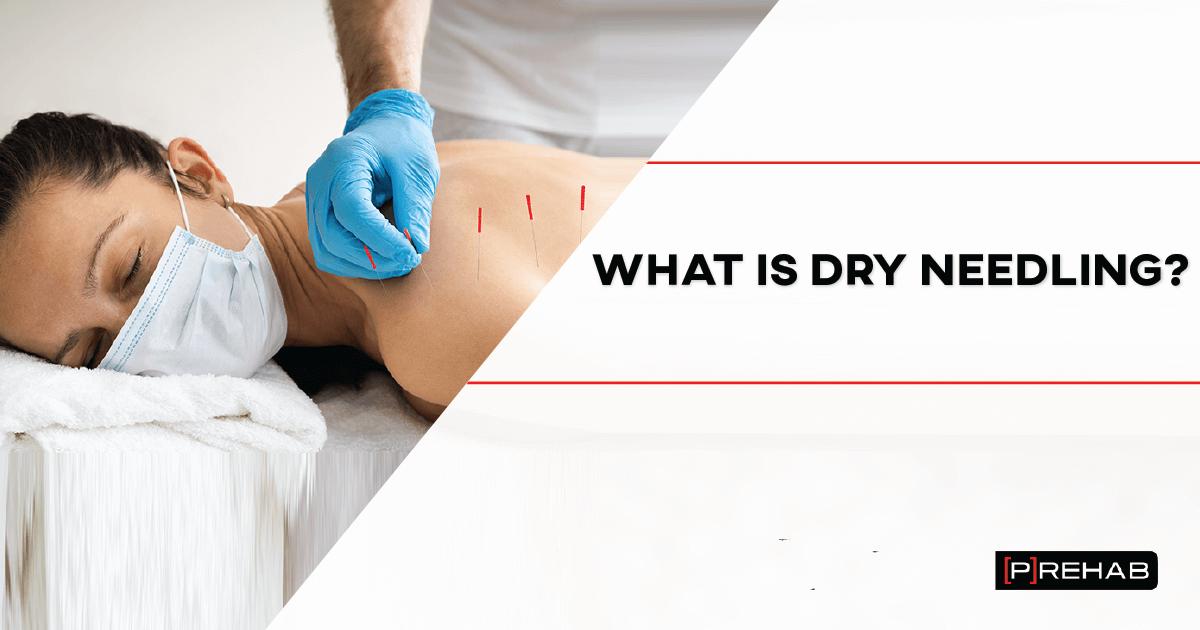 What Is Dry Needling? – [𝗣]𝗥𝗲𝗵𝗮𝗯
