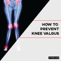 How To Prevent Knee Valgus With Exercise - [P]rehab